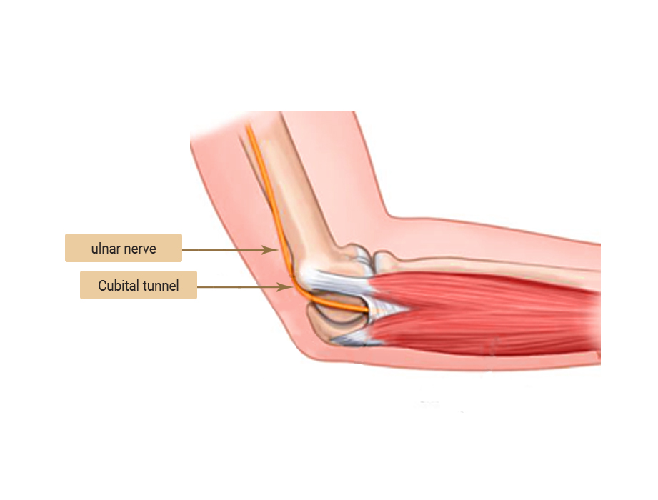 Cubital Tunnel Syndrome Ulnar Nerve Entrapment