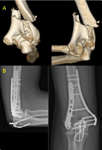 Distal Humerus Anatomy