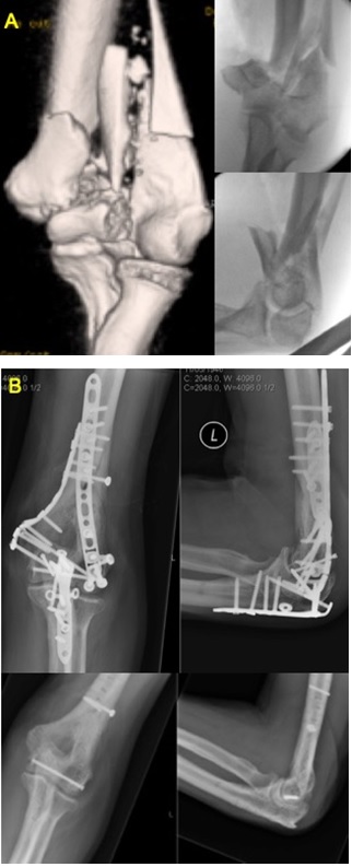 Distal Humerus Fracture