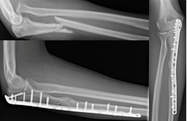 Elbow Olecranon Fractures Dr Groh