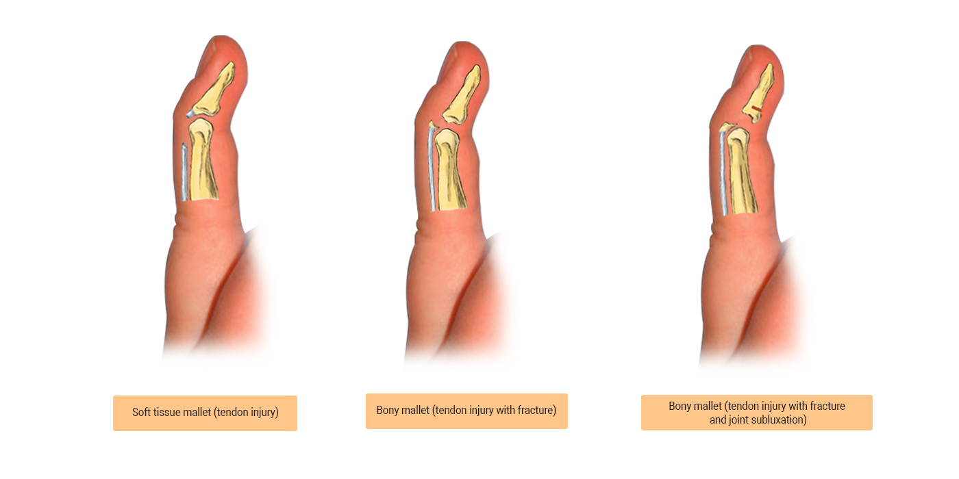 Mallet Finger Healing Process