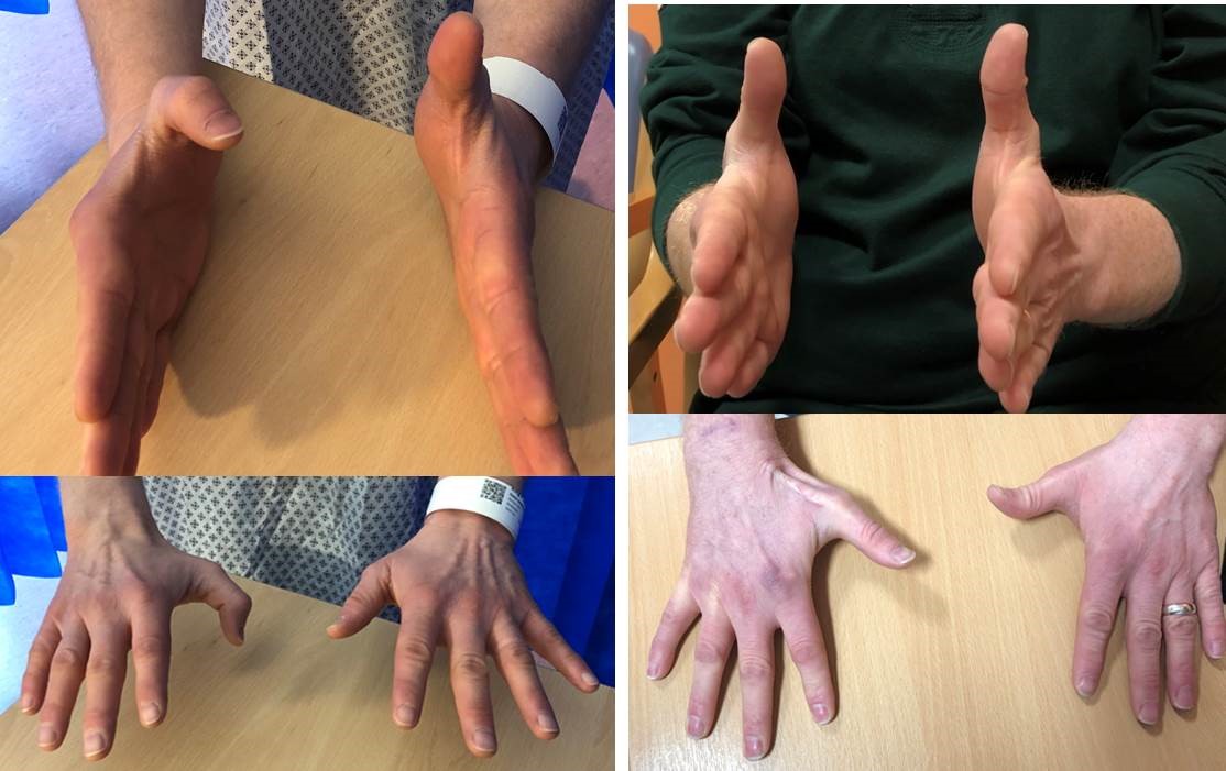 Extensor Pollicis Brevis Pain