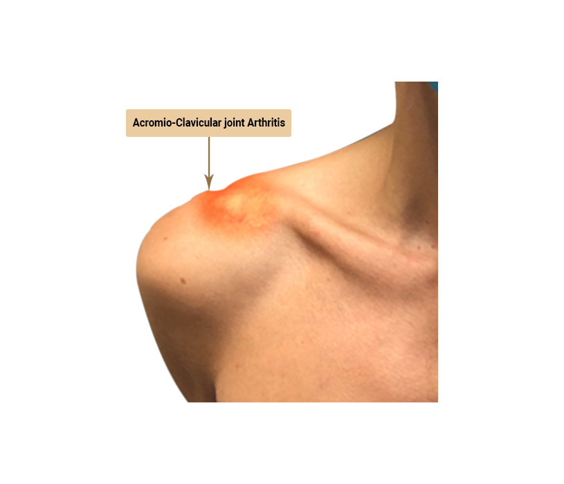 Clavicle Bone Sticking Out