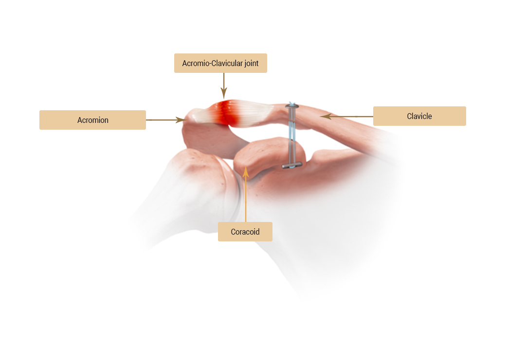London Upper Limb Surgery
