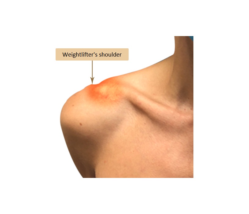 Symptoms Of Osteolysis