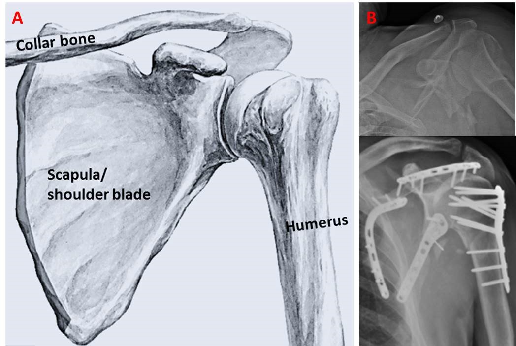 Scapula Umerket Physiotherapy In Kleinburg For Snapping Scapula