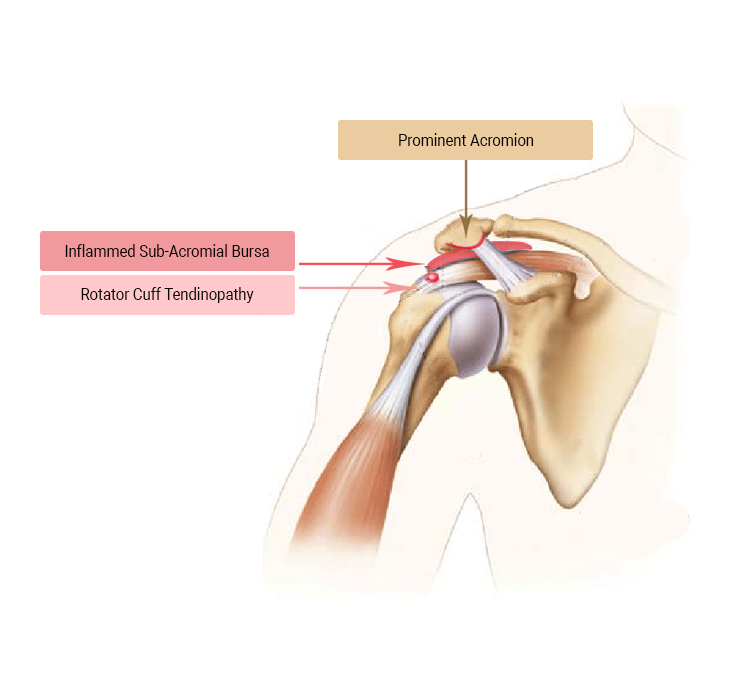 Rotator Cuff Impingement